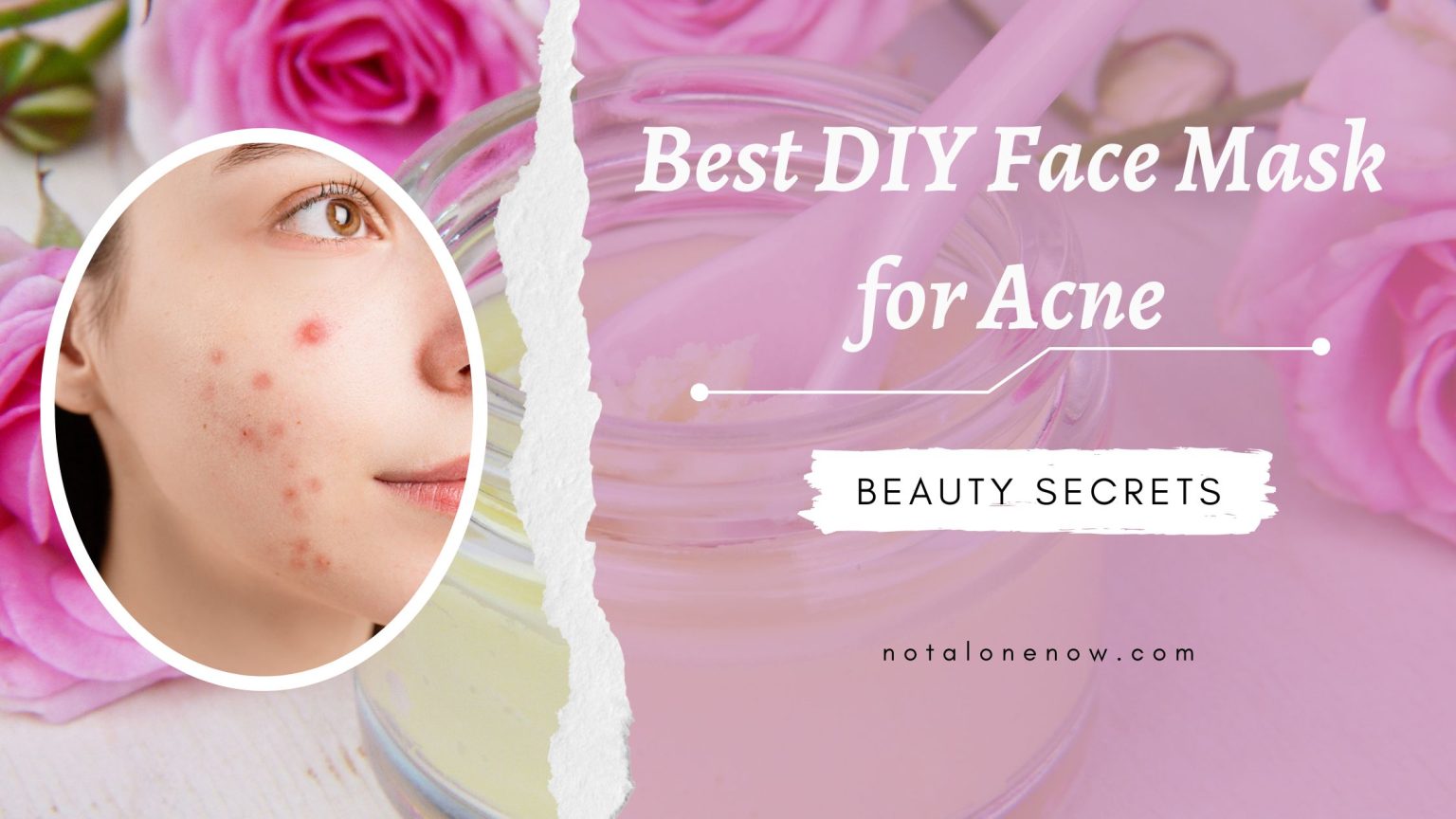 Best DIY Face Pack for Pimples & Acne Treatment » Noah's Digest
